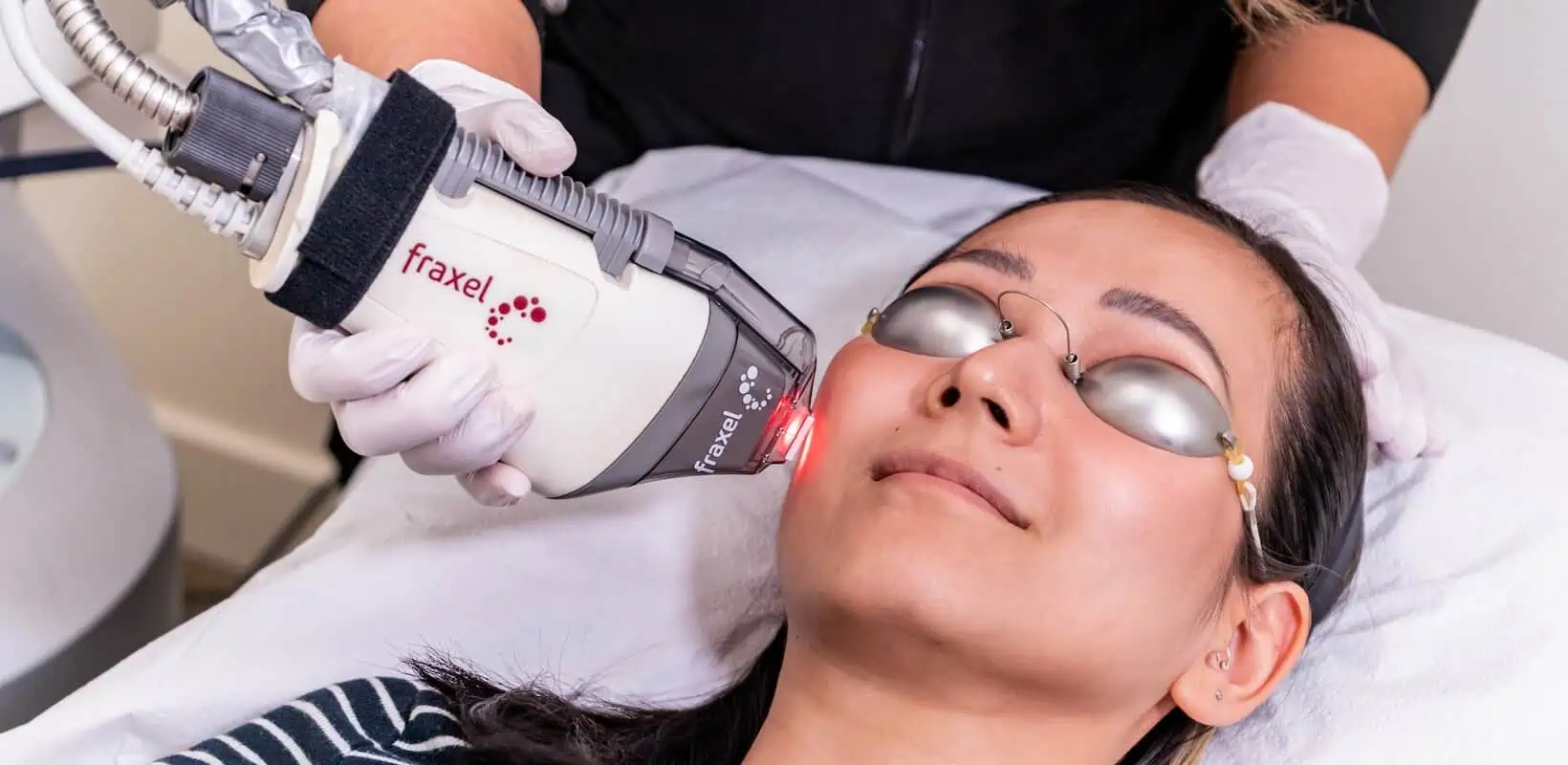 Fraxel laser - DERMACARE, Skin, Cosmetology and Hair clinic
